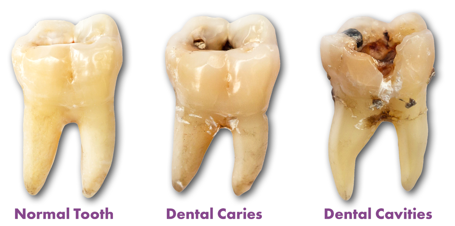 Tooth Cavity Symptoms: What to Know and When to Act - Surfside Smiles